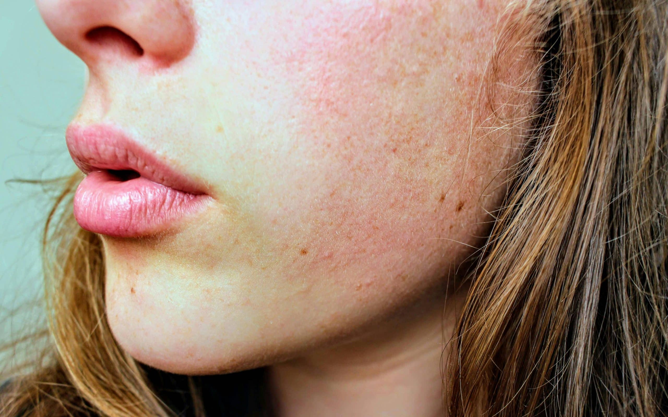 Atópiás dermatitis jelentése, tünetei és kezelése